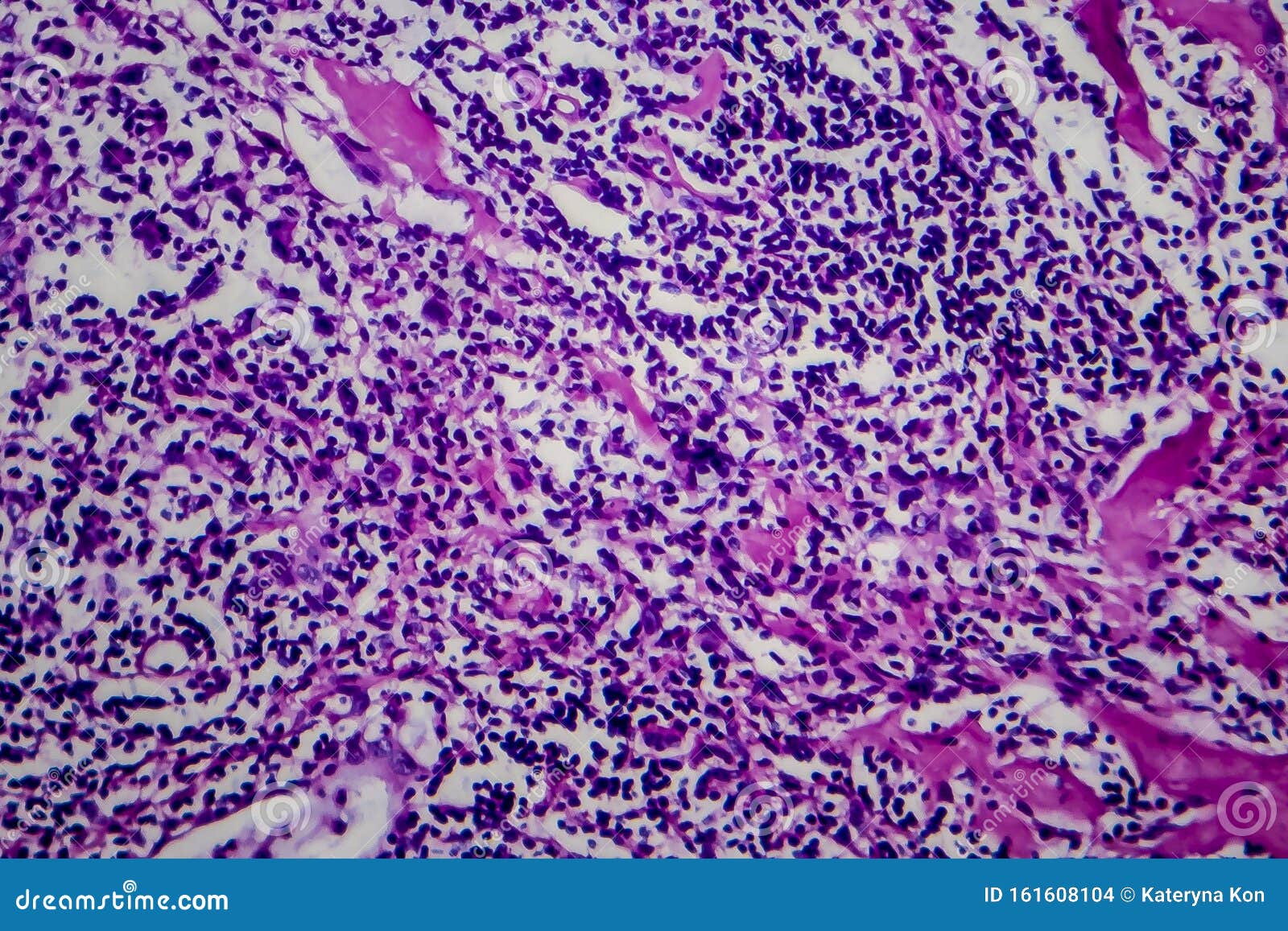 Hodgkin`s Lymphoma, Light Micrograph Stock Photo - Image of ...
