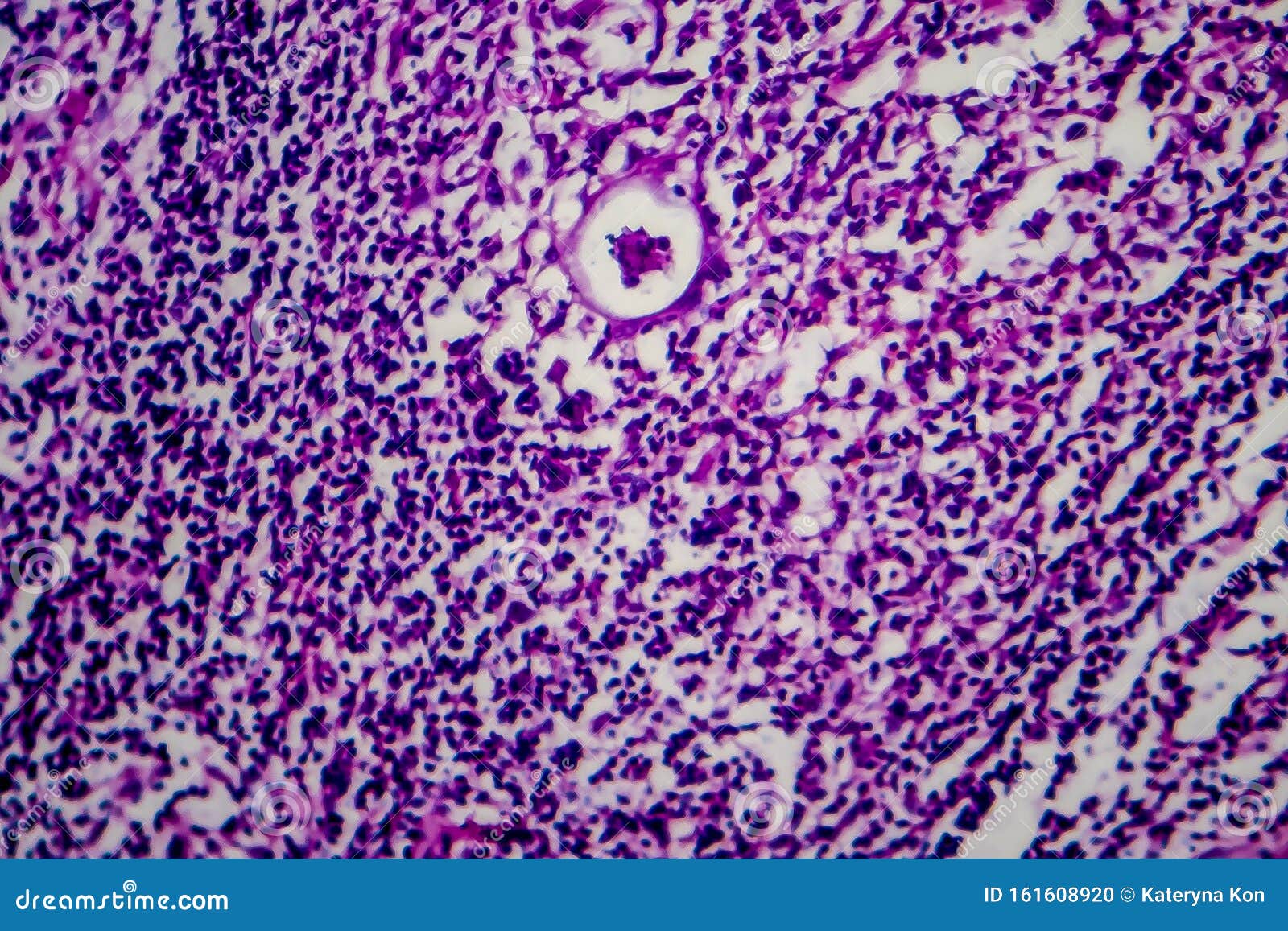 Hodgkin`s Lymphoma, Light Micrograph Stock Photo - Image of tissue ...