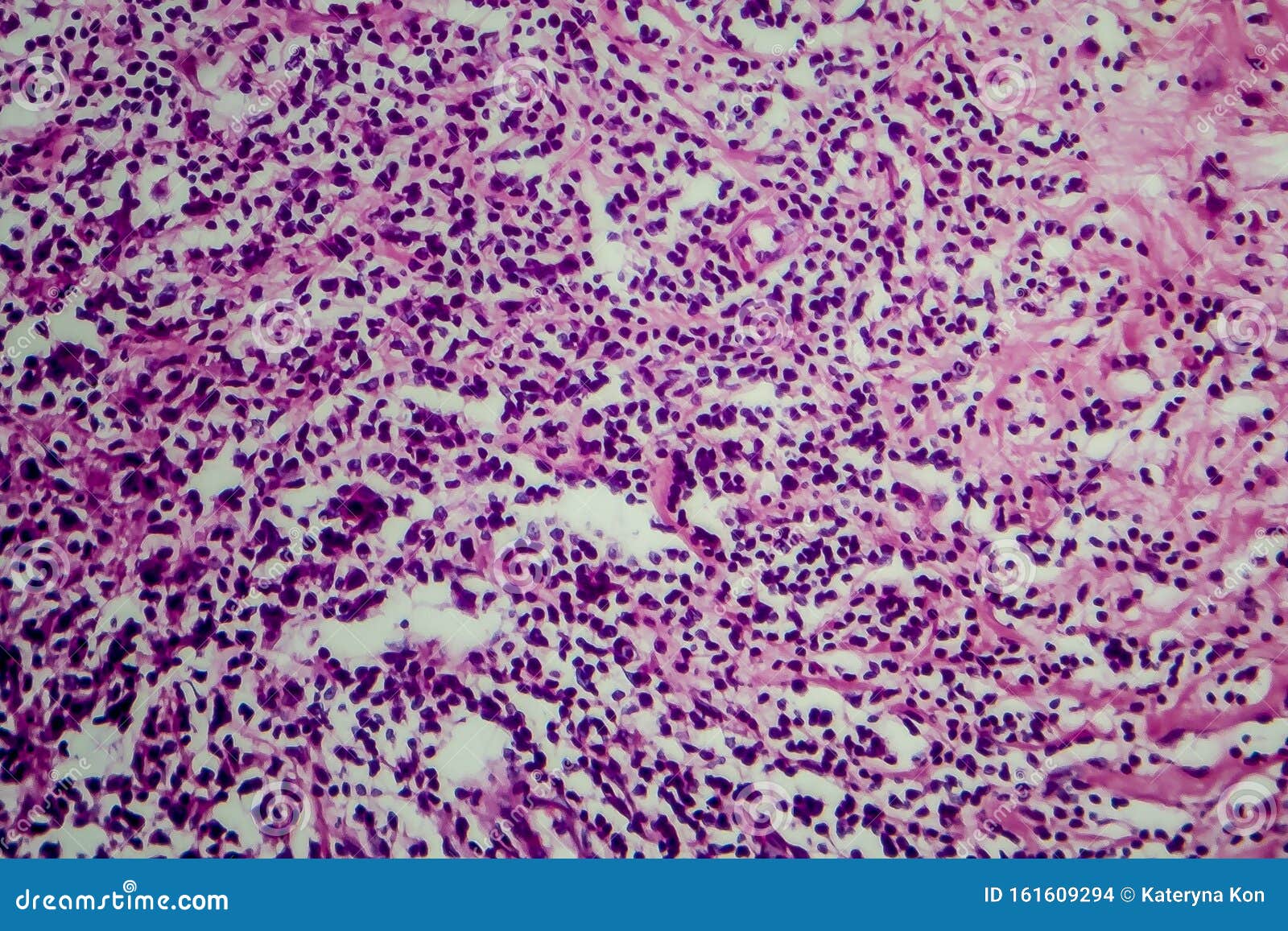 Hodgkin`s Lymphoma, Light Micrograph Stock Photo - Image of tissue ...