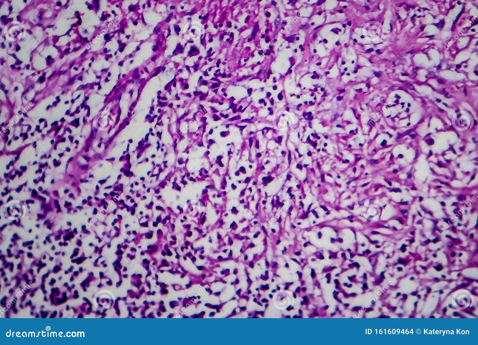 Hodgkin`s Lymphoma, Light Micrograph Stock Photo - Image of medicine ...