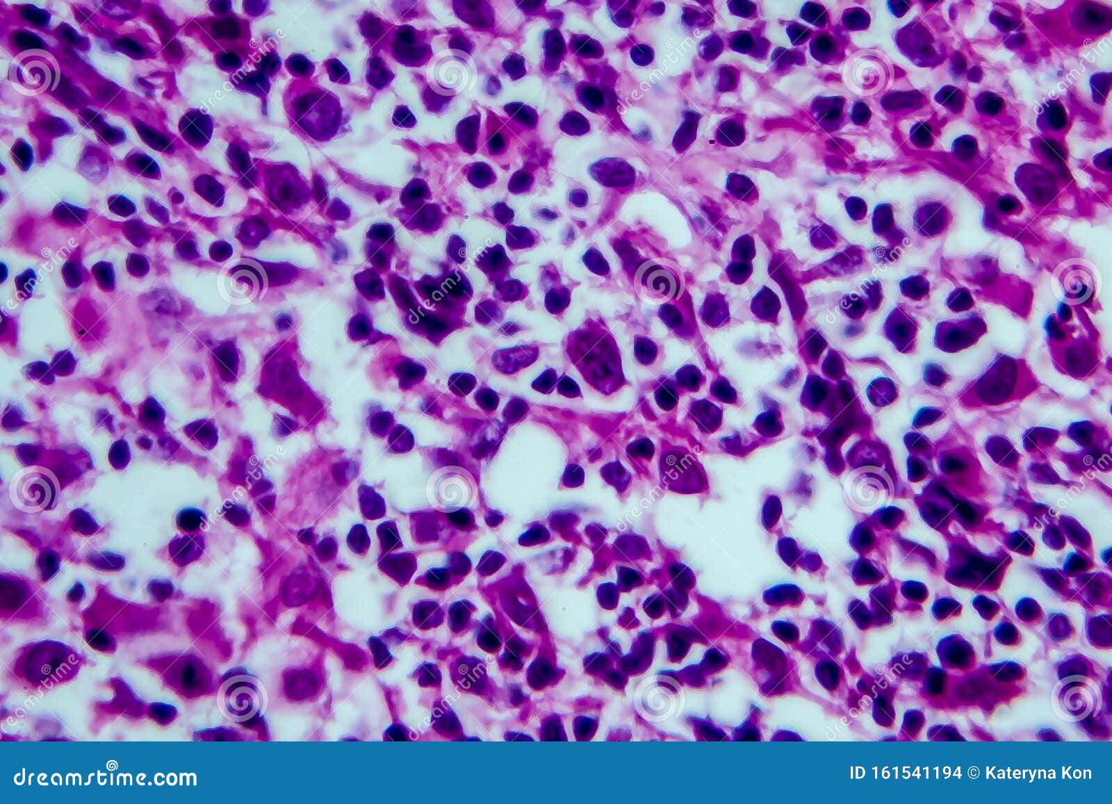 Hodgkin`s Lymphoma, Light Micrograph Stock Photo - Image of lymphoma ...