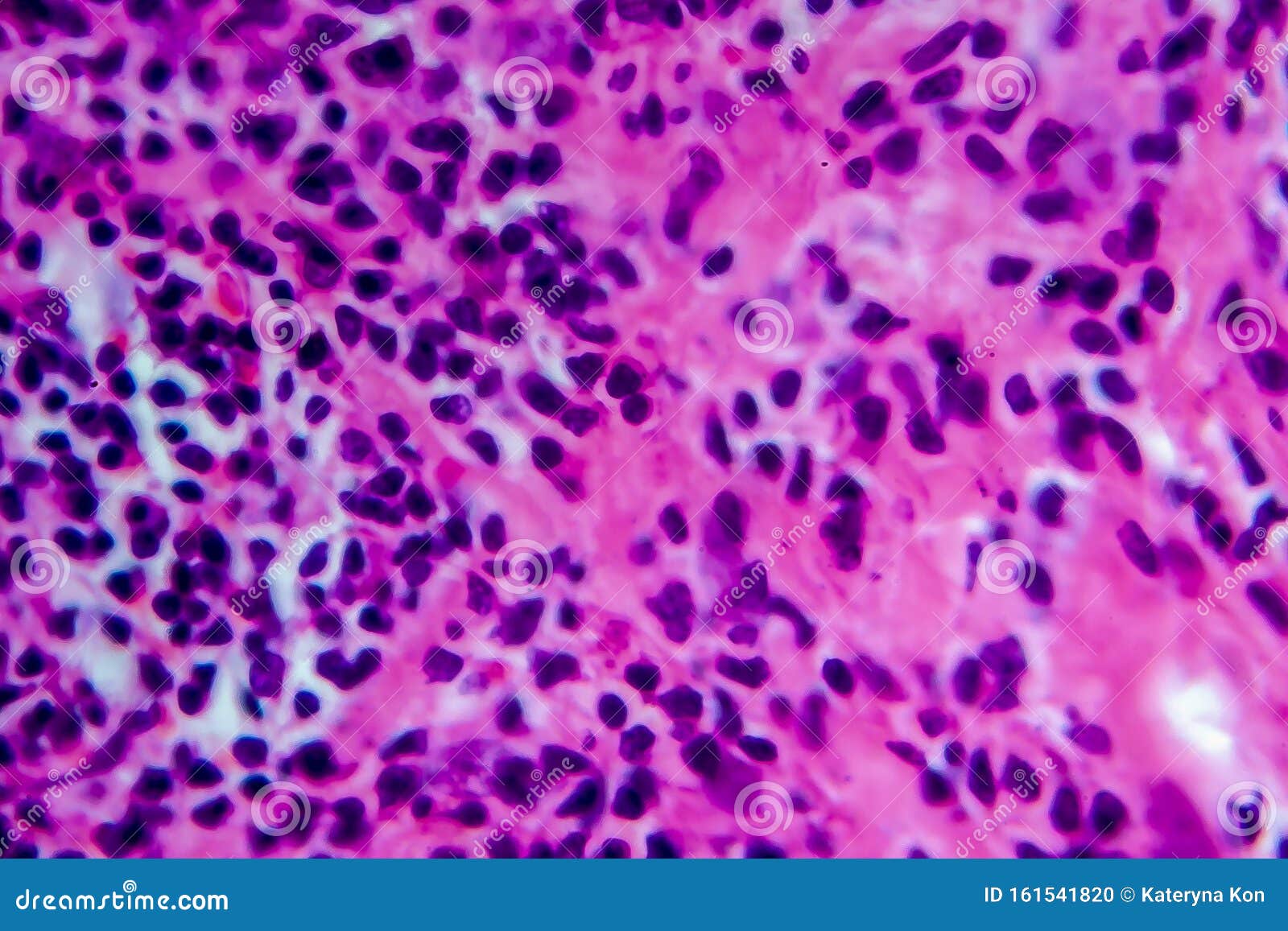 Hodgkin`s Lymphoma, Light Micrograph Stock Photo - Image of eosin, high ...