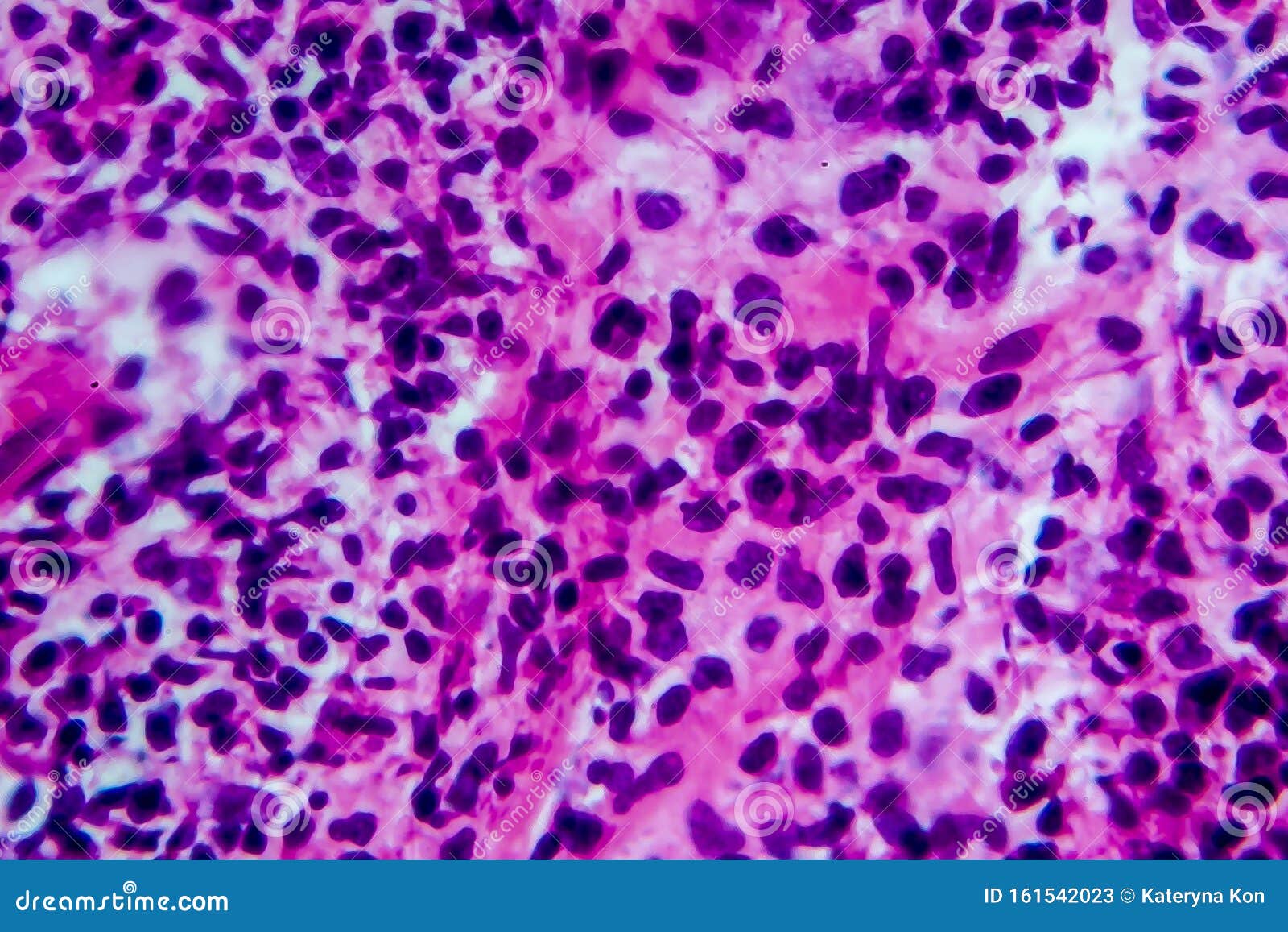 Hodgkin`s Lymphoma, Light Micrograph Stock Image - Image of cell ...