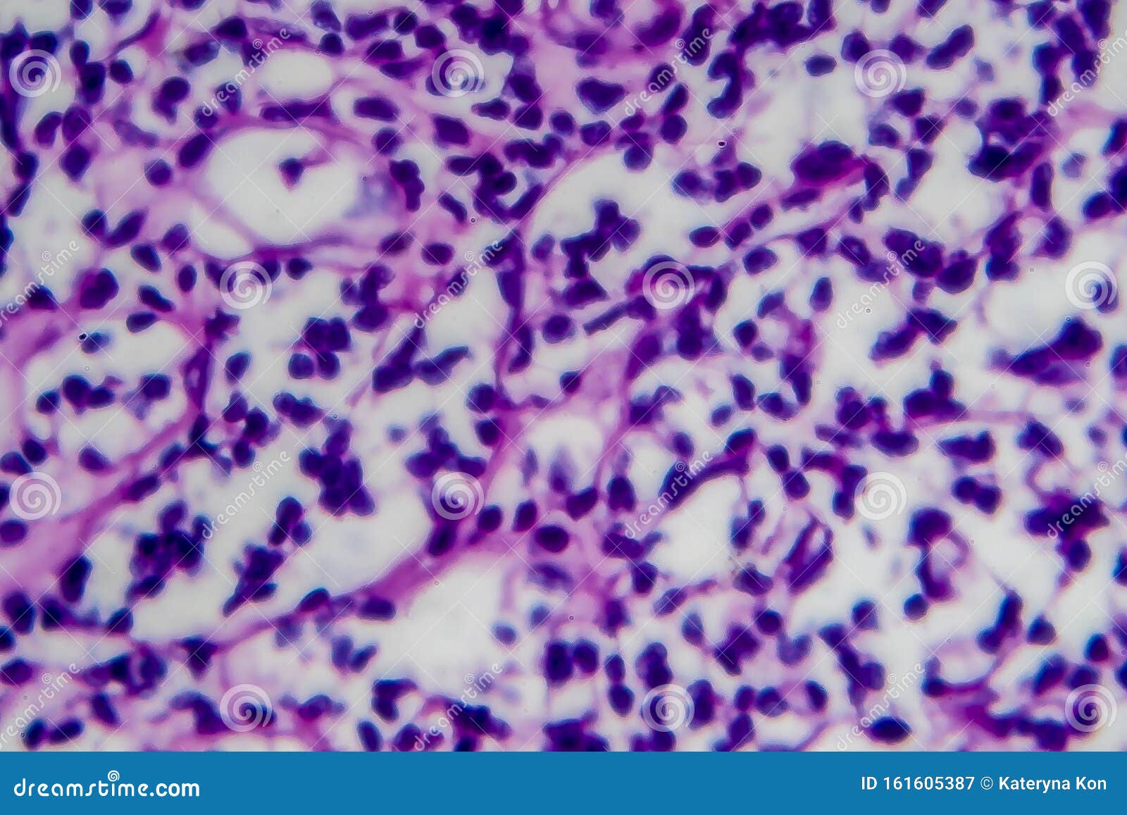 Hodgkin`s Lymphoma, Light Micrograph Stock Image - Image of ...