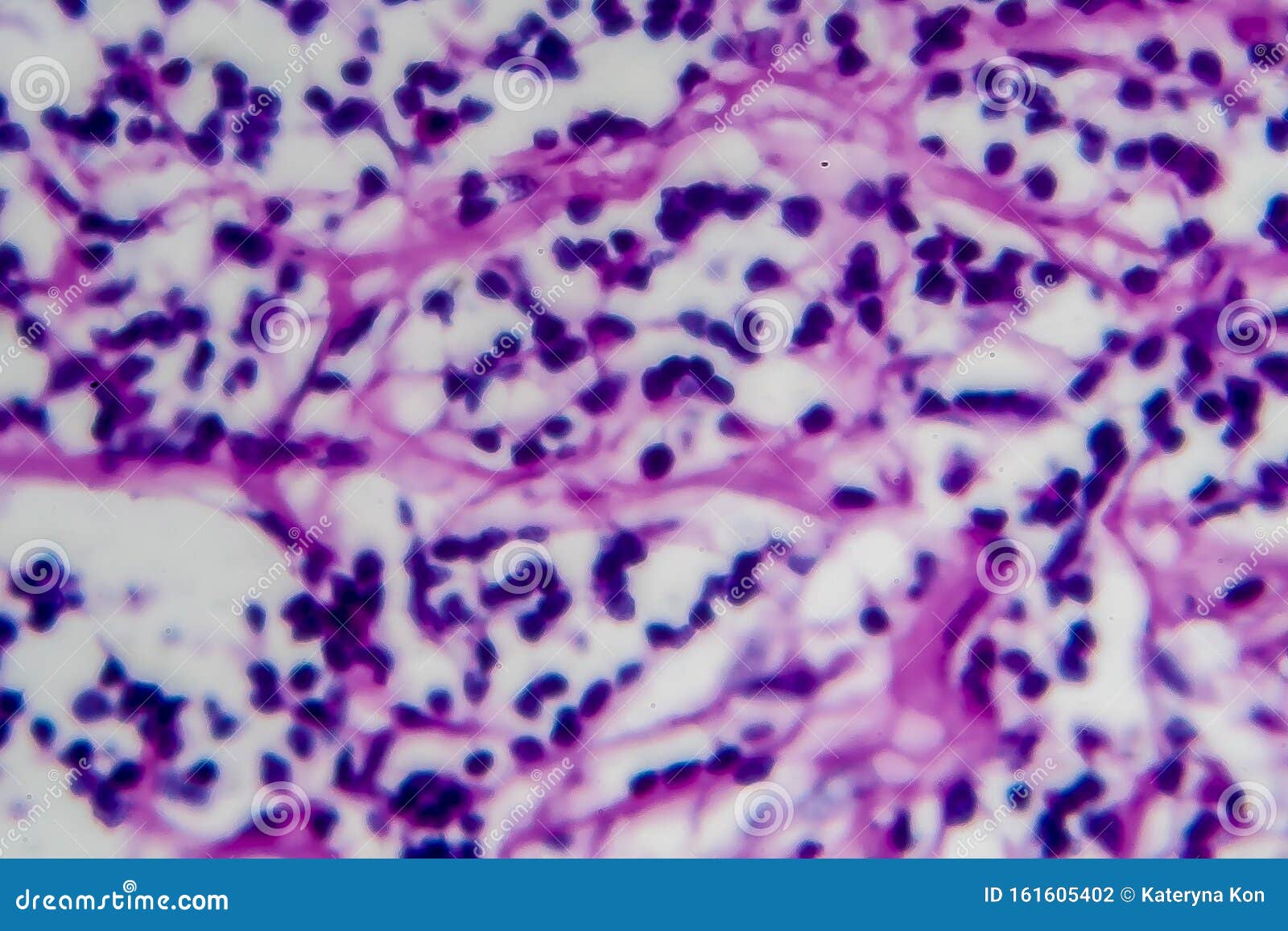 Hodgkin`s Lymphoma, Light Micrograph Stock Photo - Image of lymphoma ...