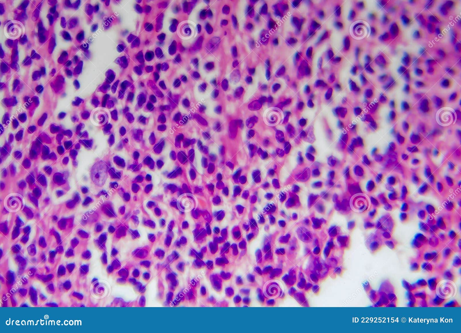 Hodgkin S Lymphoma, Light Micrograph Stock Photo - Image of hematoxylin ...