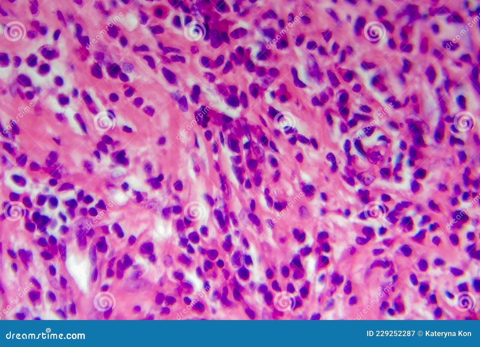 Hodgkin S Lymphoma, Light Micrograph Stock Image - Image of blood ...