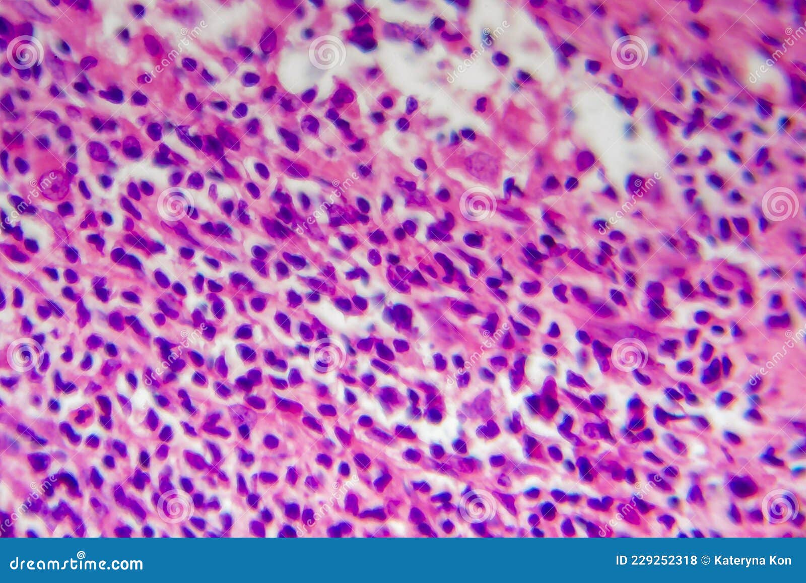 Hodgkin S Lymphoma, Light Micrograph Stock Photo - Image of white ...