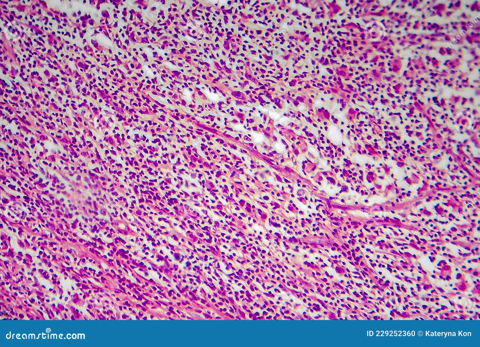 Hodgkin S Lymphoma, Light Micrograph Stock Photo - Image of blood ...