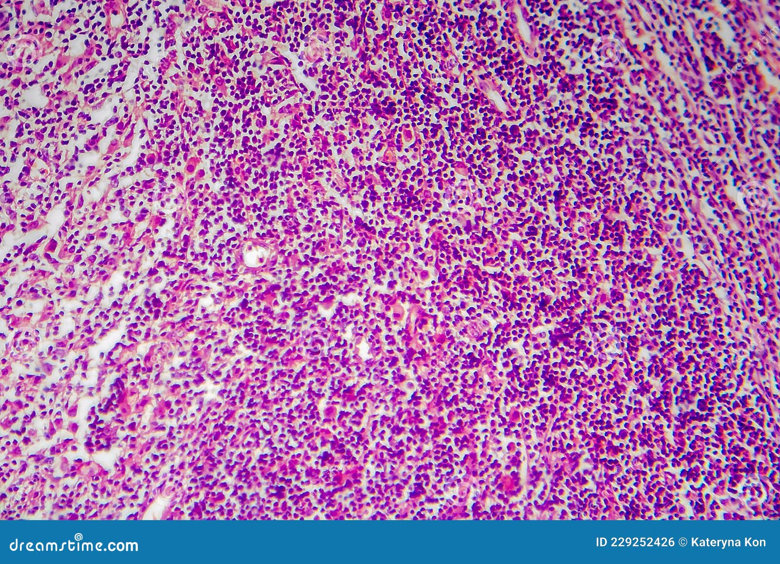 Hodgkin S Lymphoma, Light Micrograph Stock Photo - Image of microscopic ...