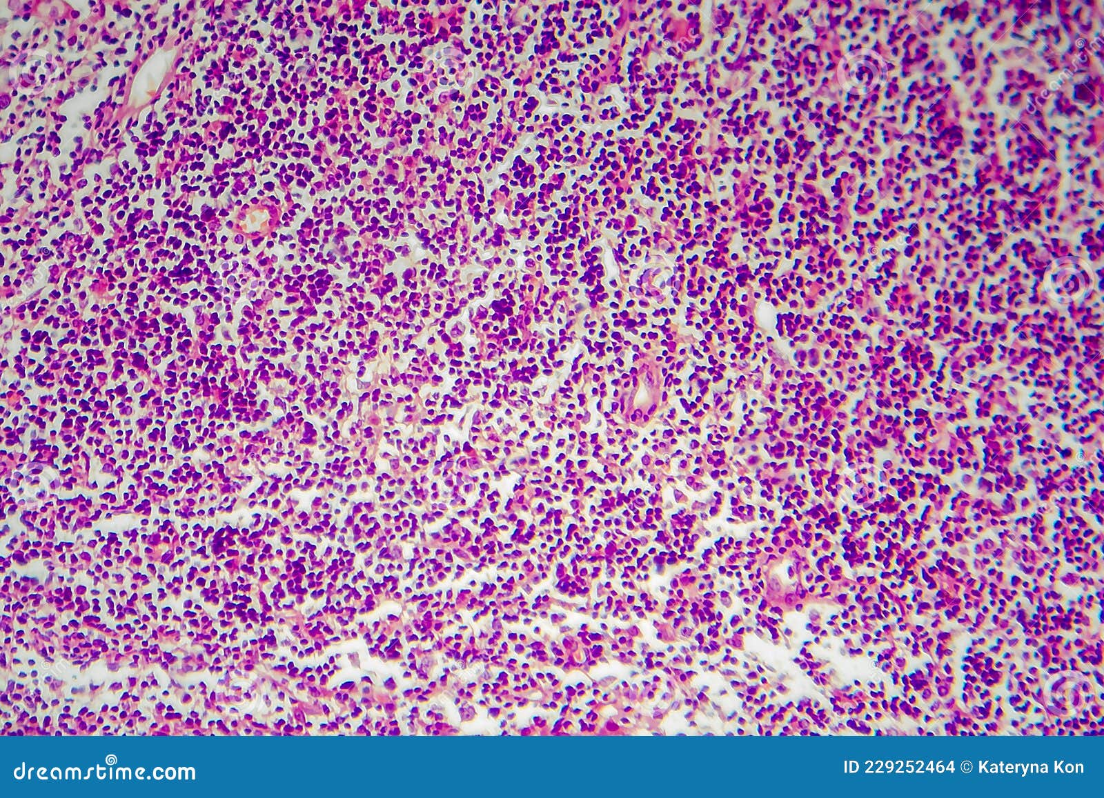 Hodgkin S Lymphoma, Light Micrograph Stock Photo - Image of ...
