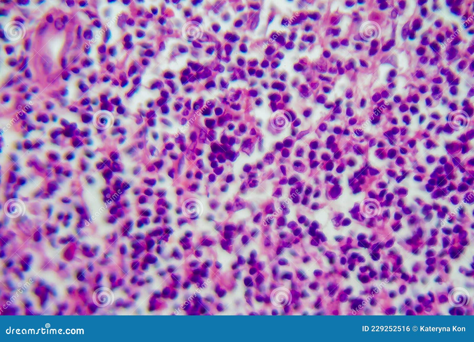 Hodgkin S Lymphoma, Light Micrograph Stock Photo - Image of ...