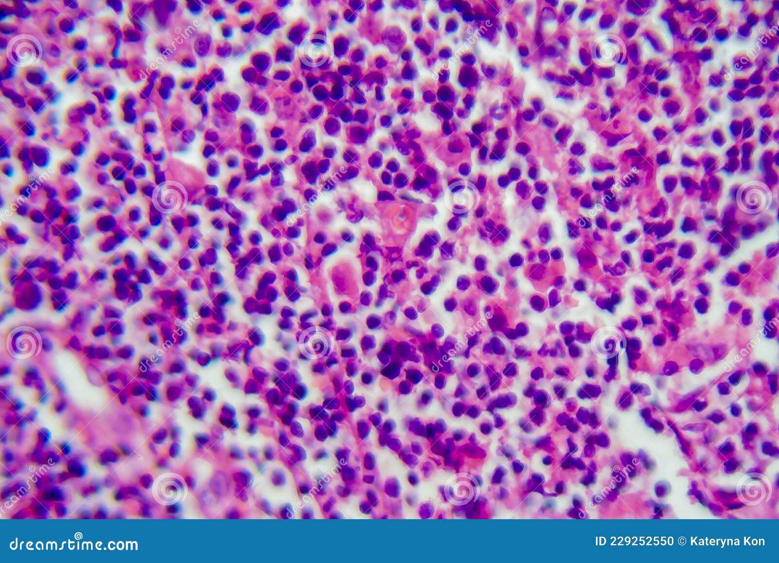 Hodgkin S Lymphoma, Light Micrograph Stock Photo - Image of microscopic ...