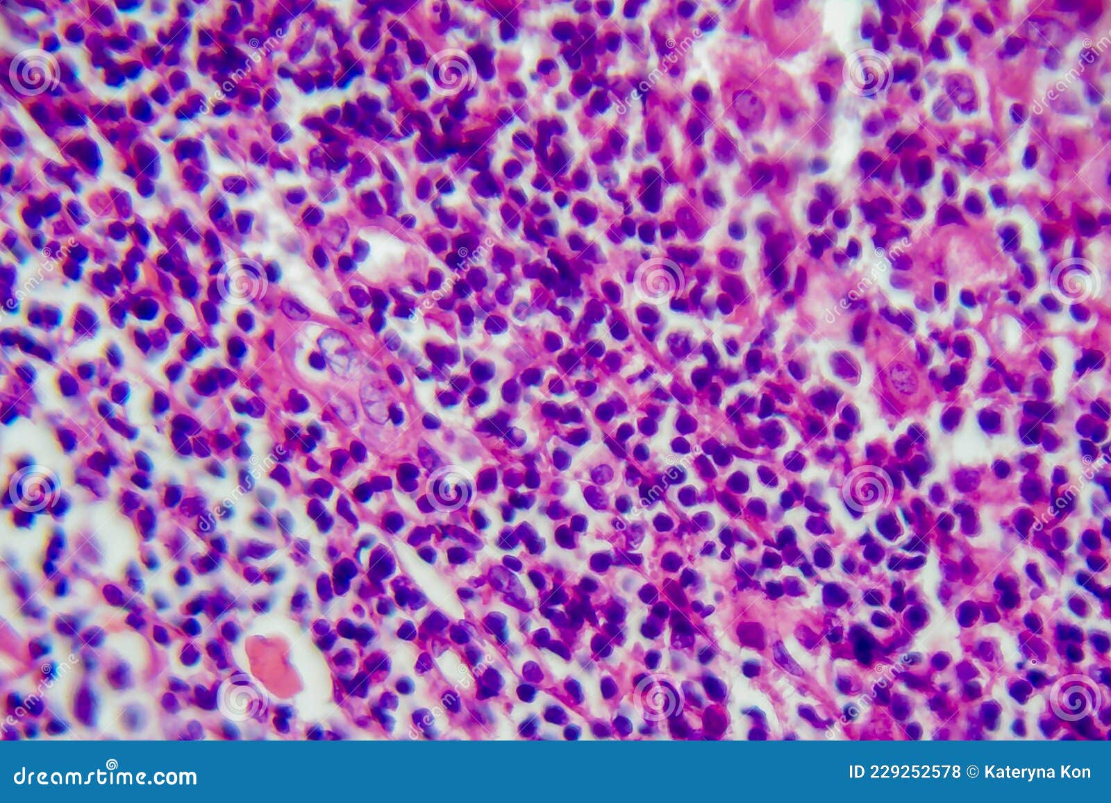 Hodgkin S Lymphoma, Light Micrograph Stock Photo - Image of ...