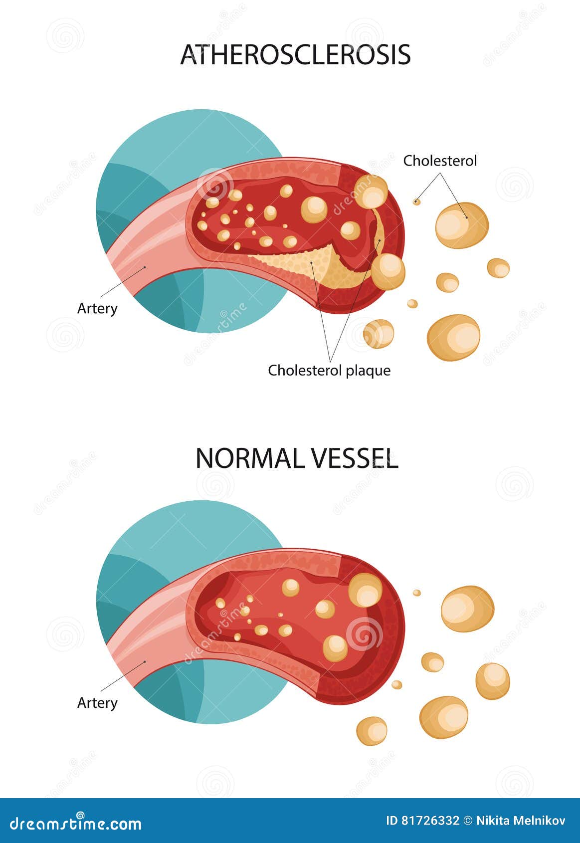Holesterol plaques stock vector. Illustration of system - 81726332