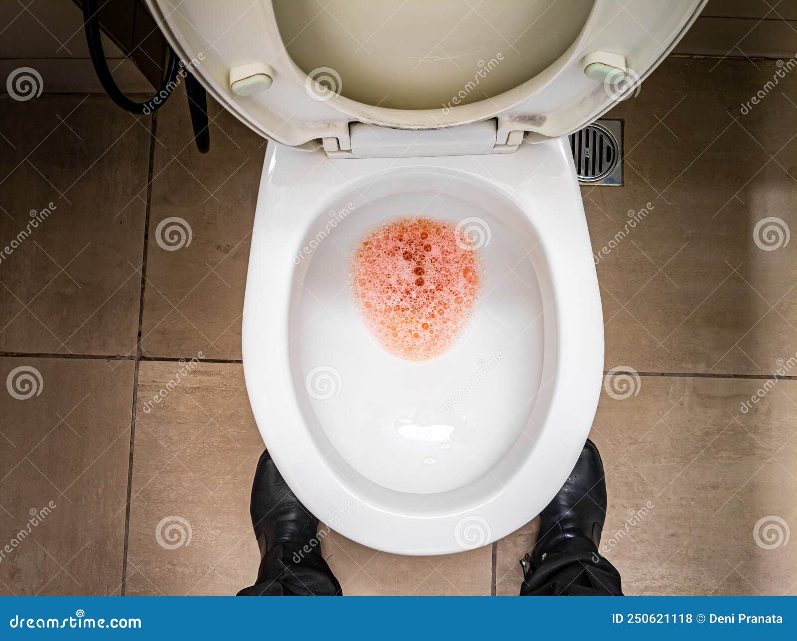 Hombre Con Orina Roja De Espuma. Foto de archivo - Imagen de sangriento ...