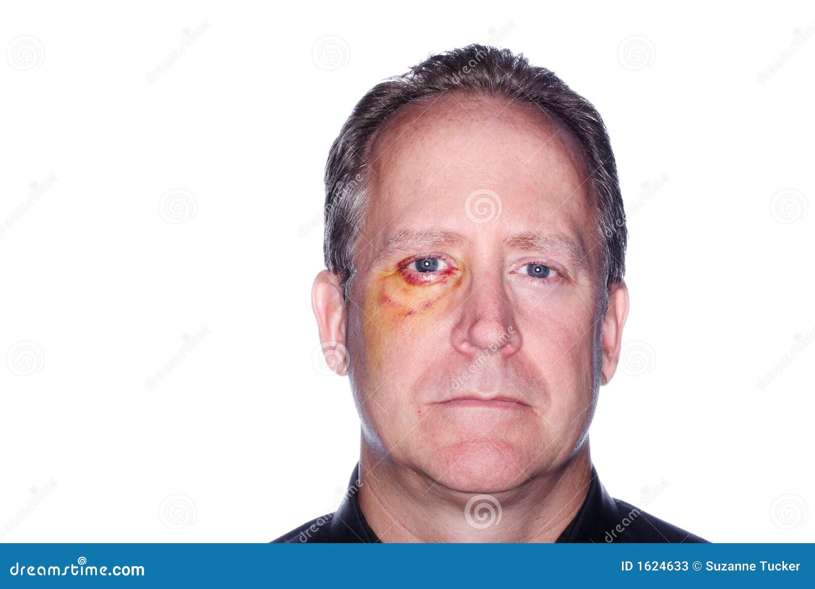 Hombre con un ojo morado imagen de archivo. Imagen de dolorido - 1624633
