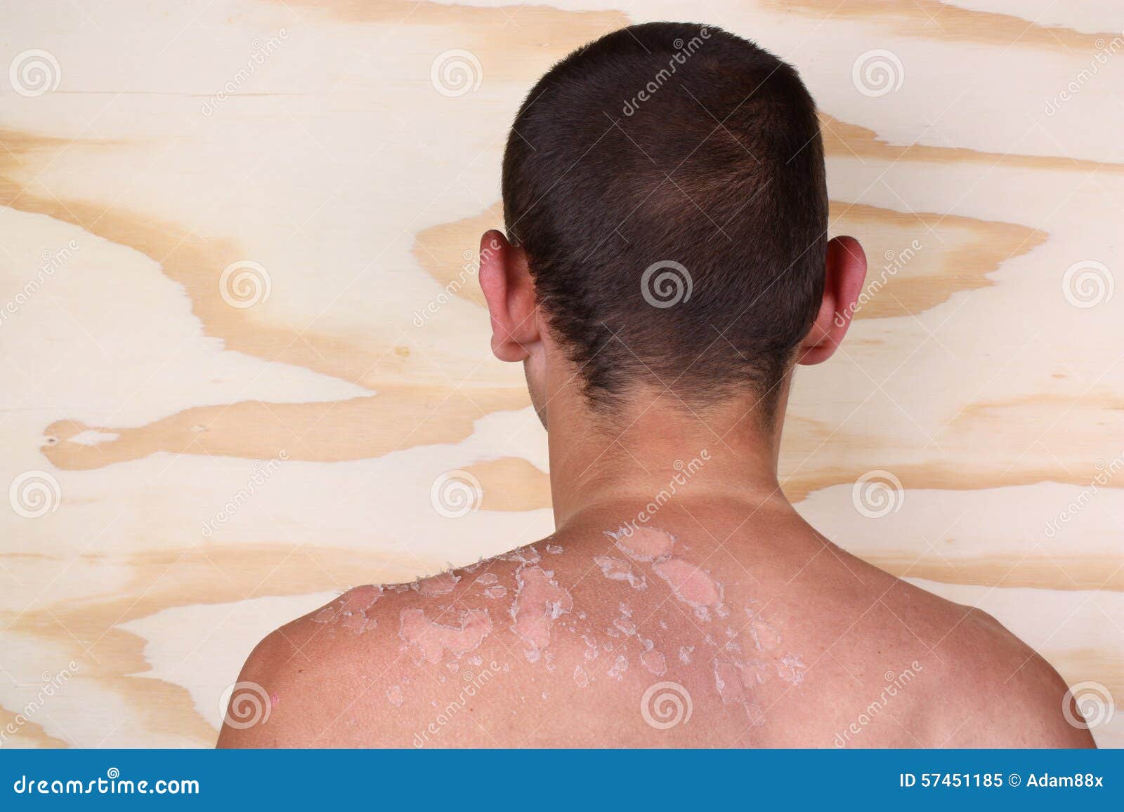 458 Hombre Quemado Por El Sol Fotos de stock - Fotos libres de regalías ...