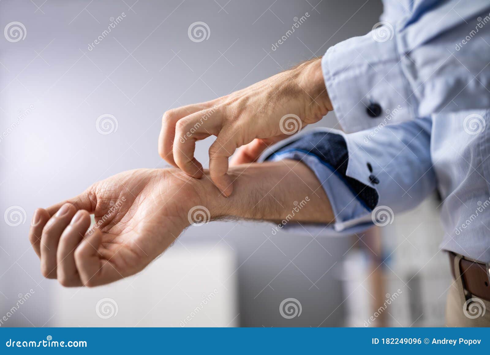 Hombre rascando su mano foto de archivo. Imagen de alérgico - 182249096