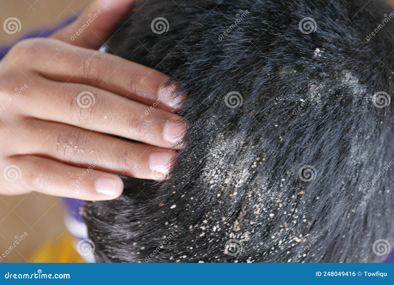 Hombres Con Caspa En El Vello Foto de archivo - Imagen de piel, salud ...