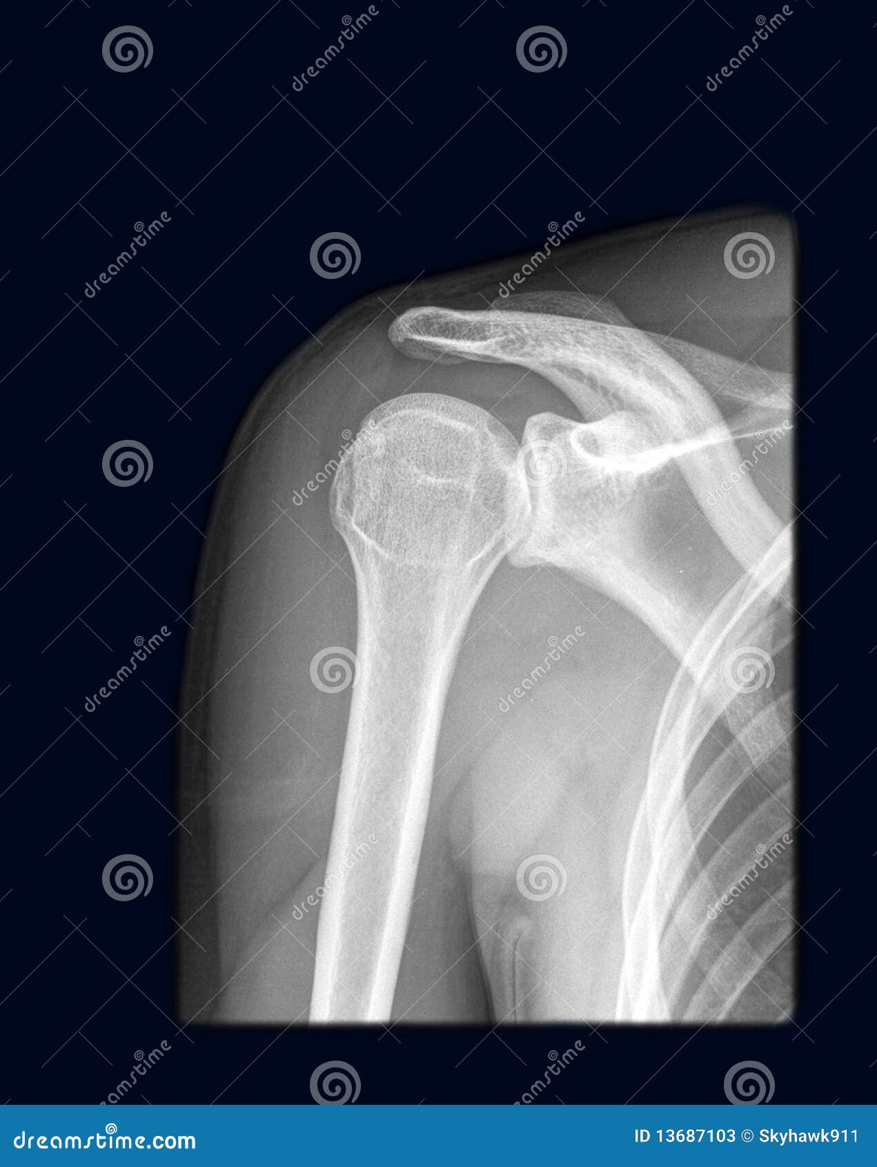 Hombro humano regular imagen de archivo. Imagen de brazo - 13687103