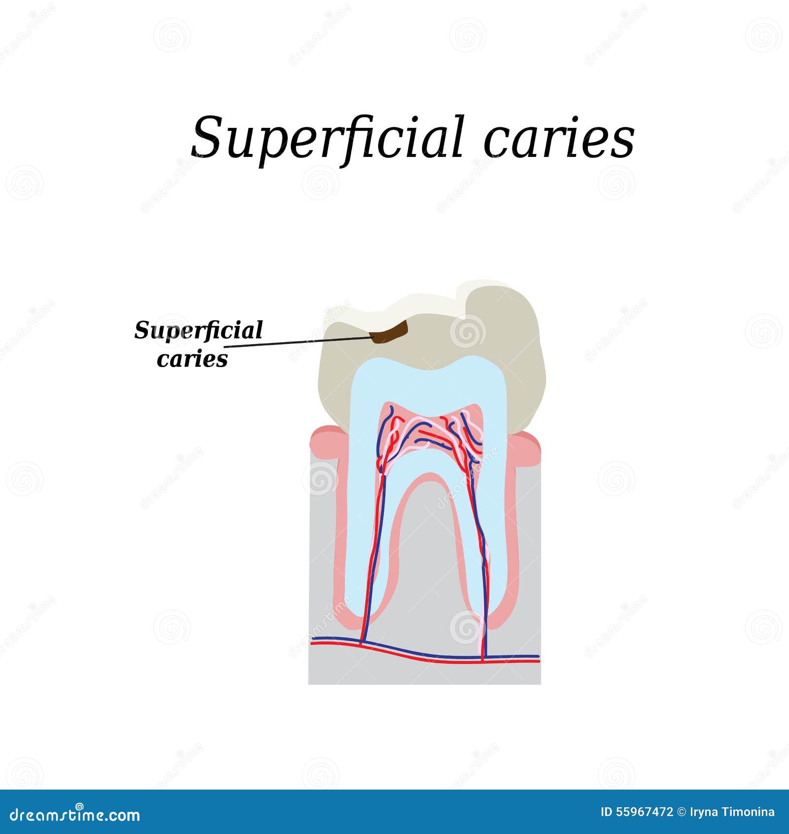 Bad Tooth With Caries Cavity And Lollipop.Sweets Provoke Dental Caries ...