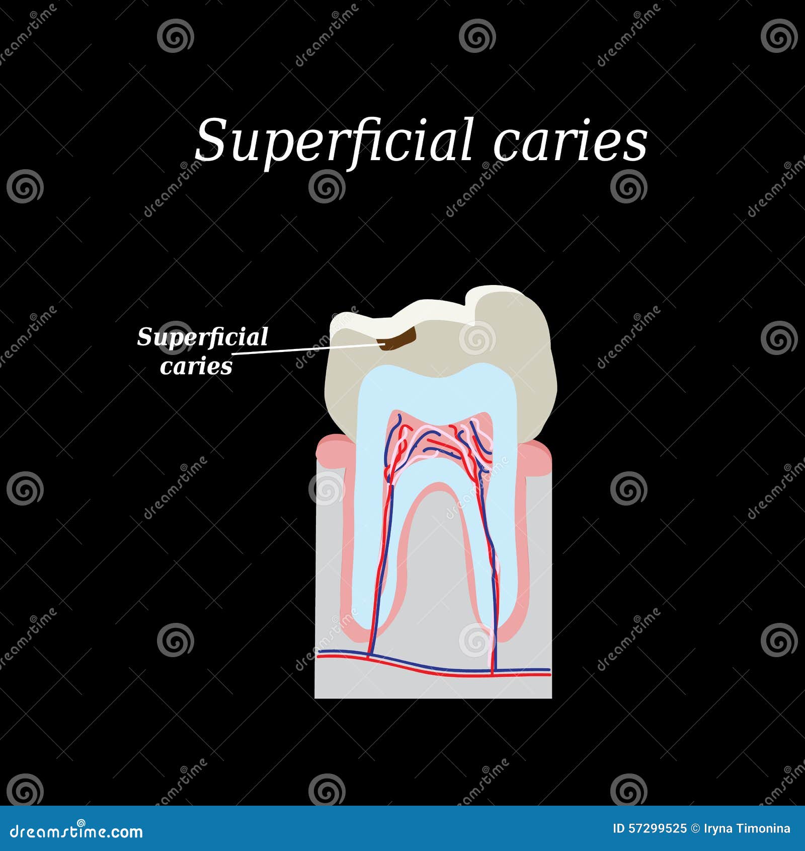 Home Tooth Caries. Vector Illustration on a Black Stock Vector ...