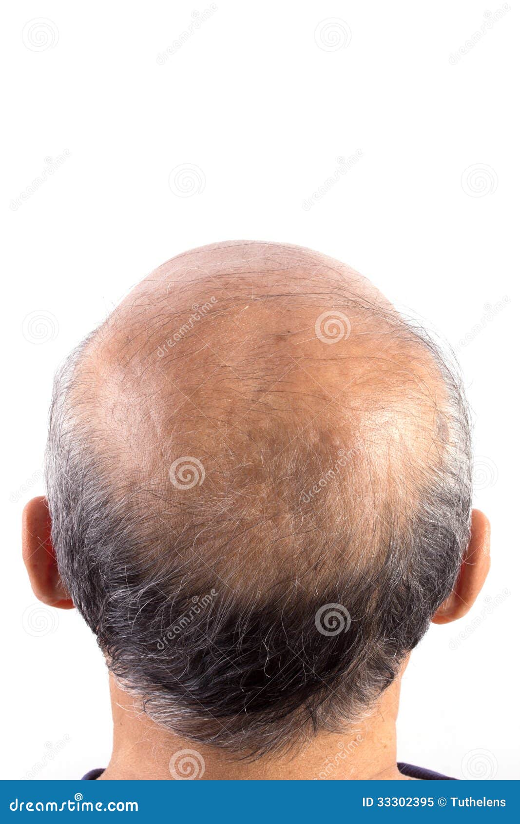 Homem Calvo Da Queda De Cabelo Imagem de Stock - Imagem de cabeleira ...