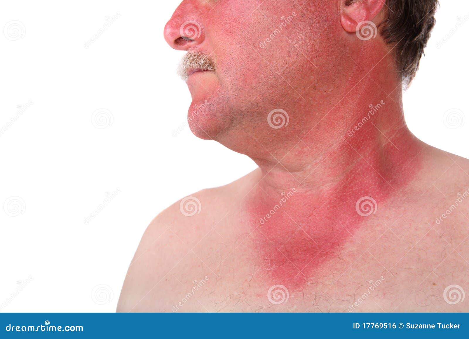 Homem com uma queimadura foto de stock. Imagem de homem - 17769516