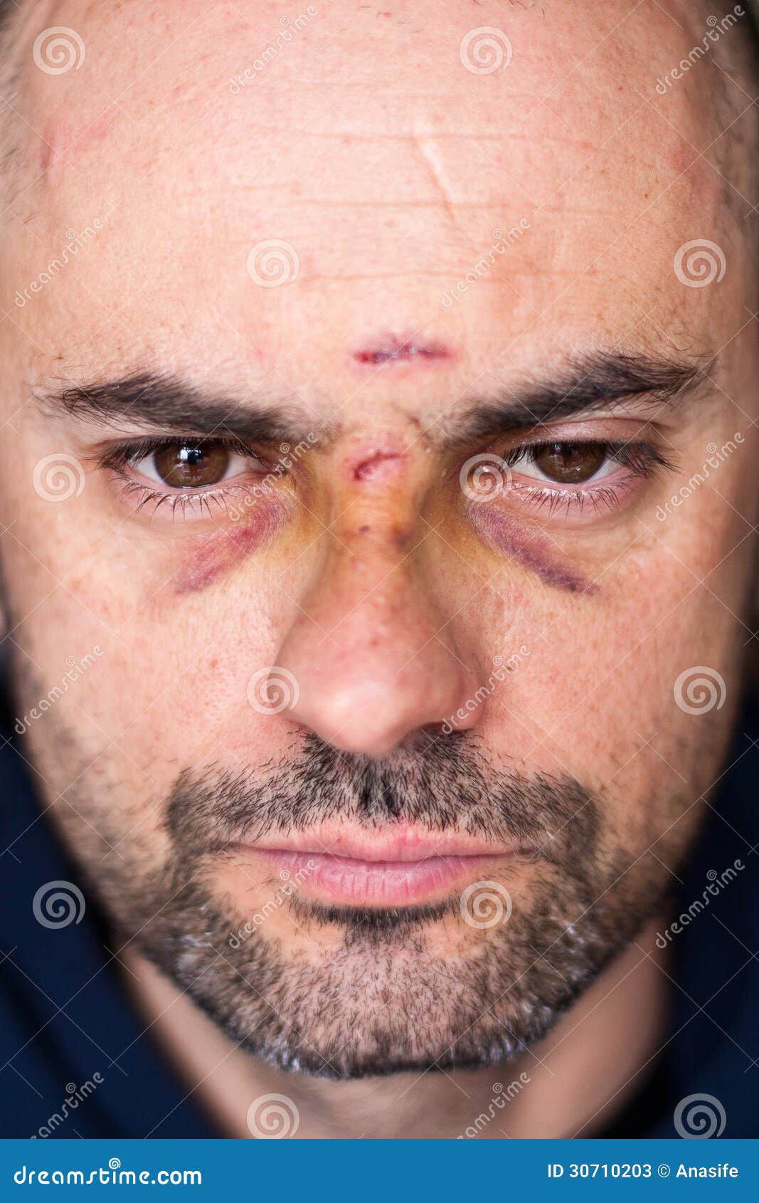 Homem Ferido Com Olhos Roxos Imagem de Stock - Imagem de corte ...