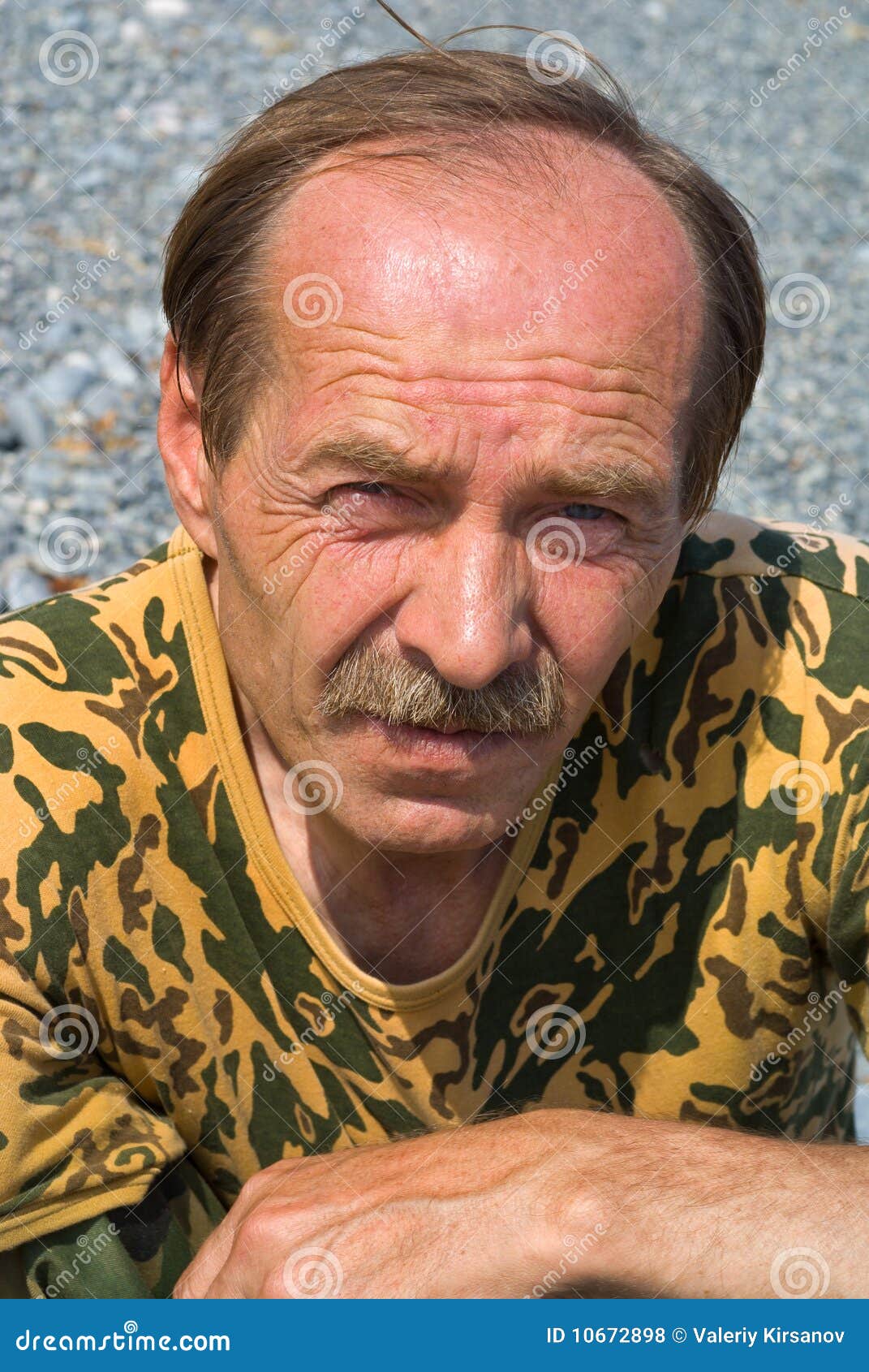 Homem queimado 1 foto de stock. Imagem de testa, adulto - 10672898