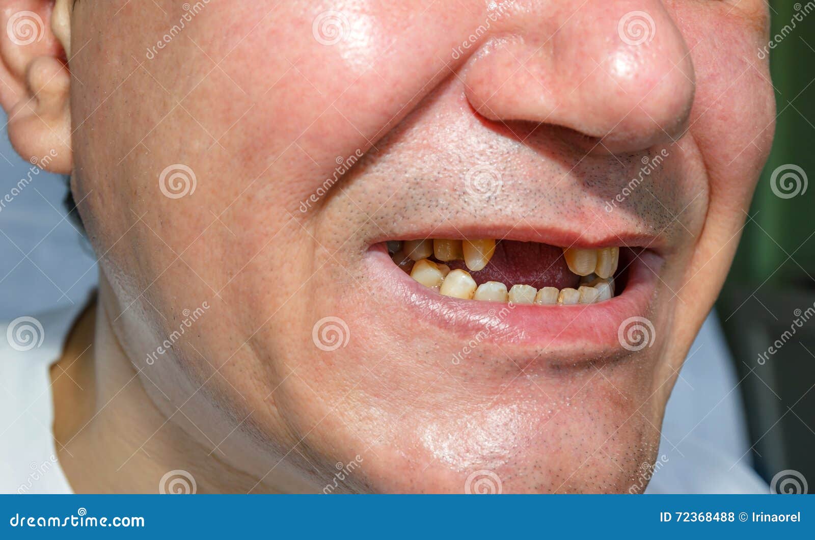 Homem Sem E Dentes Descascados Foto de Stock - Imagem de odontologia ...