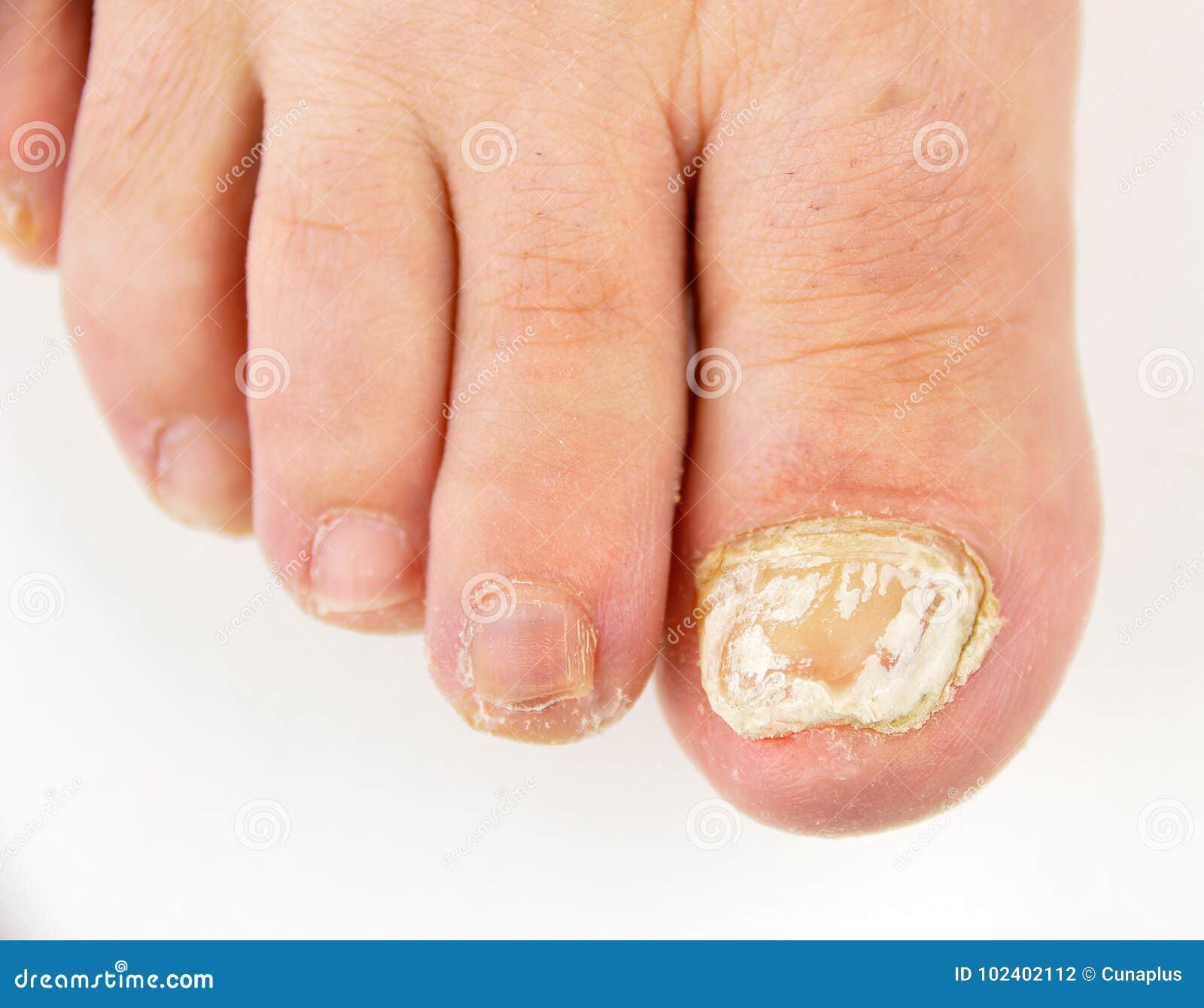 Hongo del clavo foto de archivo. Imagen de descalzo - 102402112