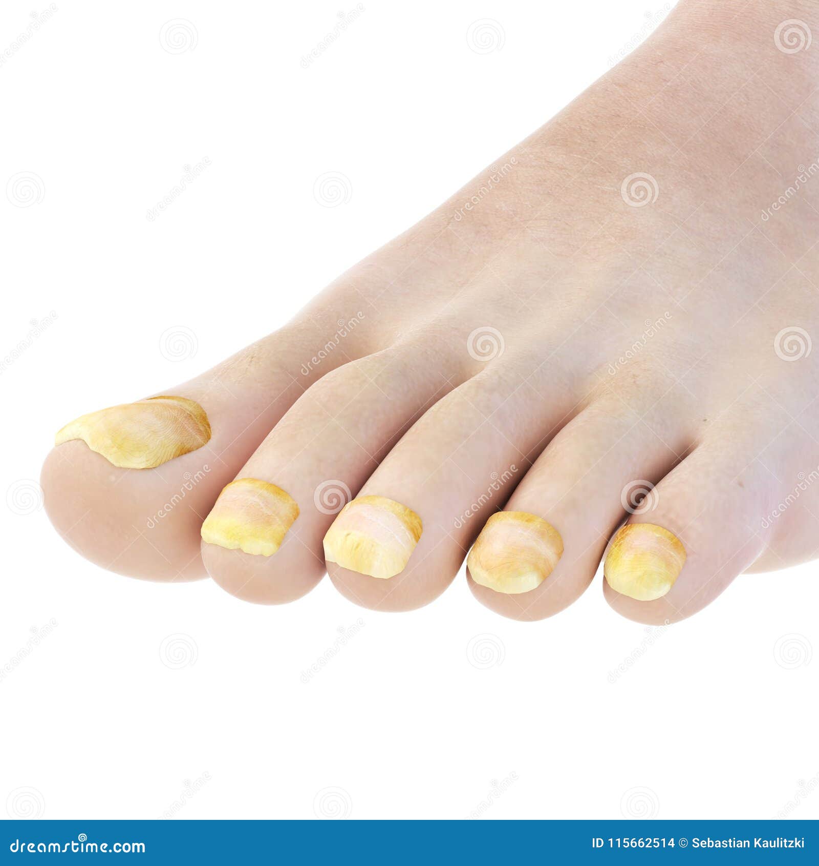 Hongo Del Clavo Del Dedo Del Pie Stock de ilustración - Ilustración de ...