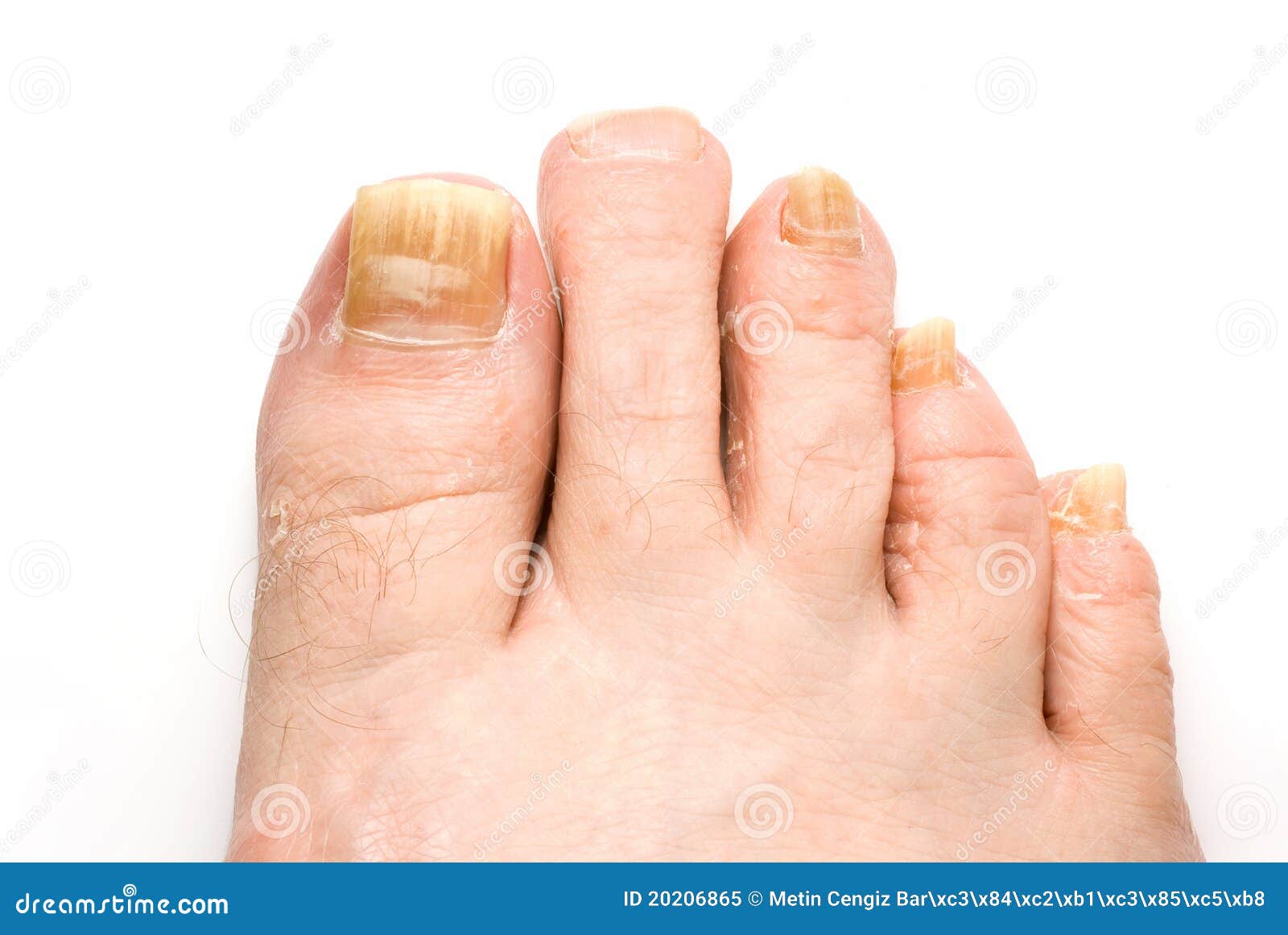 Hongo Del Uña Del Dedo Del Pie Imagen de archivo - Imagen de toenilla ...