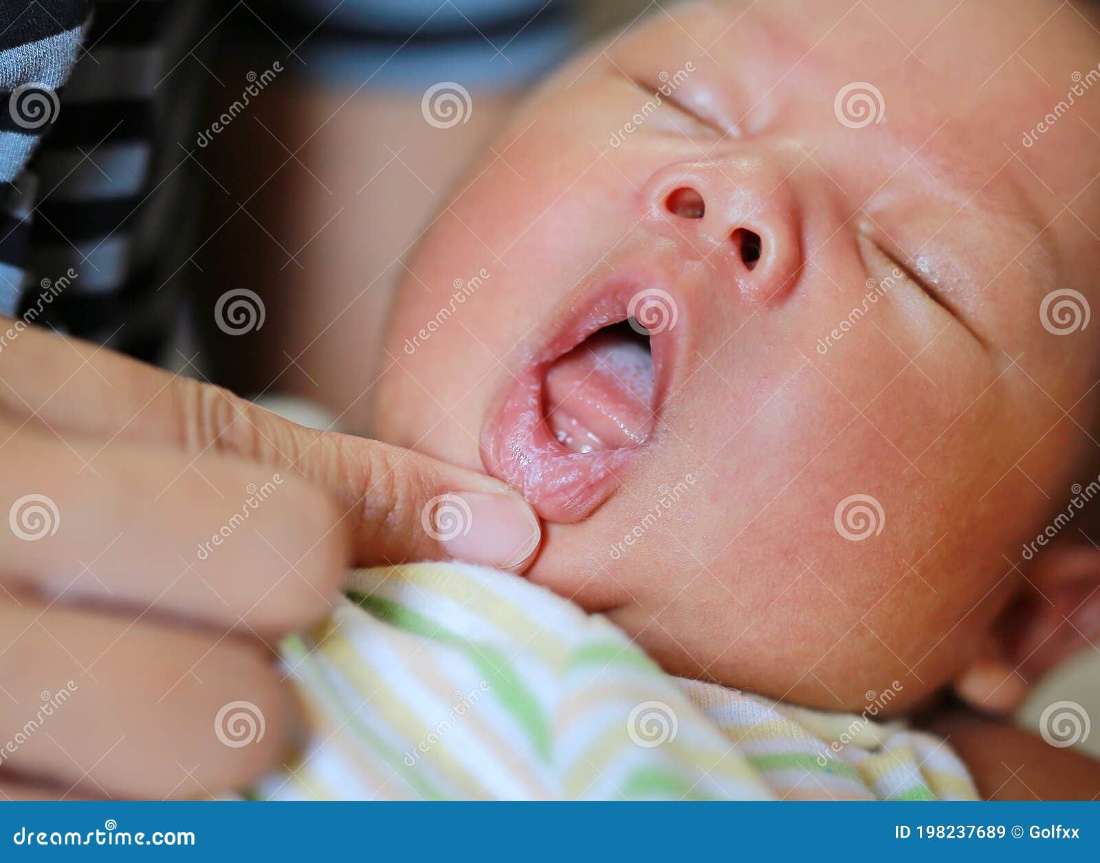 Hongos En El Labio Infantil Imagen de archivo - Imagen de dedos, capa ...