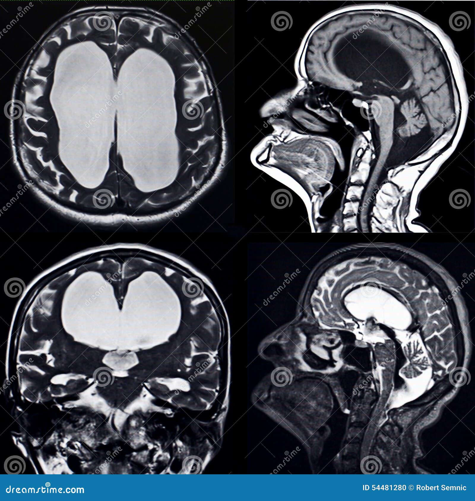 Hoofdpijn, Hersenen MRI stock foto. Image of geïsoleerd - 54481280