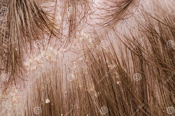 Hoofdroos stock foto. Image of kwaadaardigheid, psoriasis - 30788278