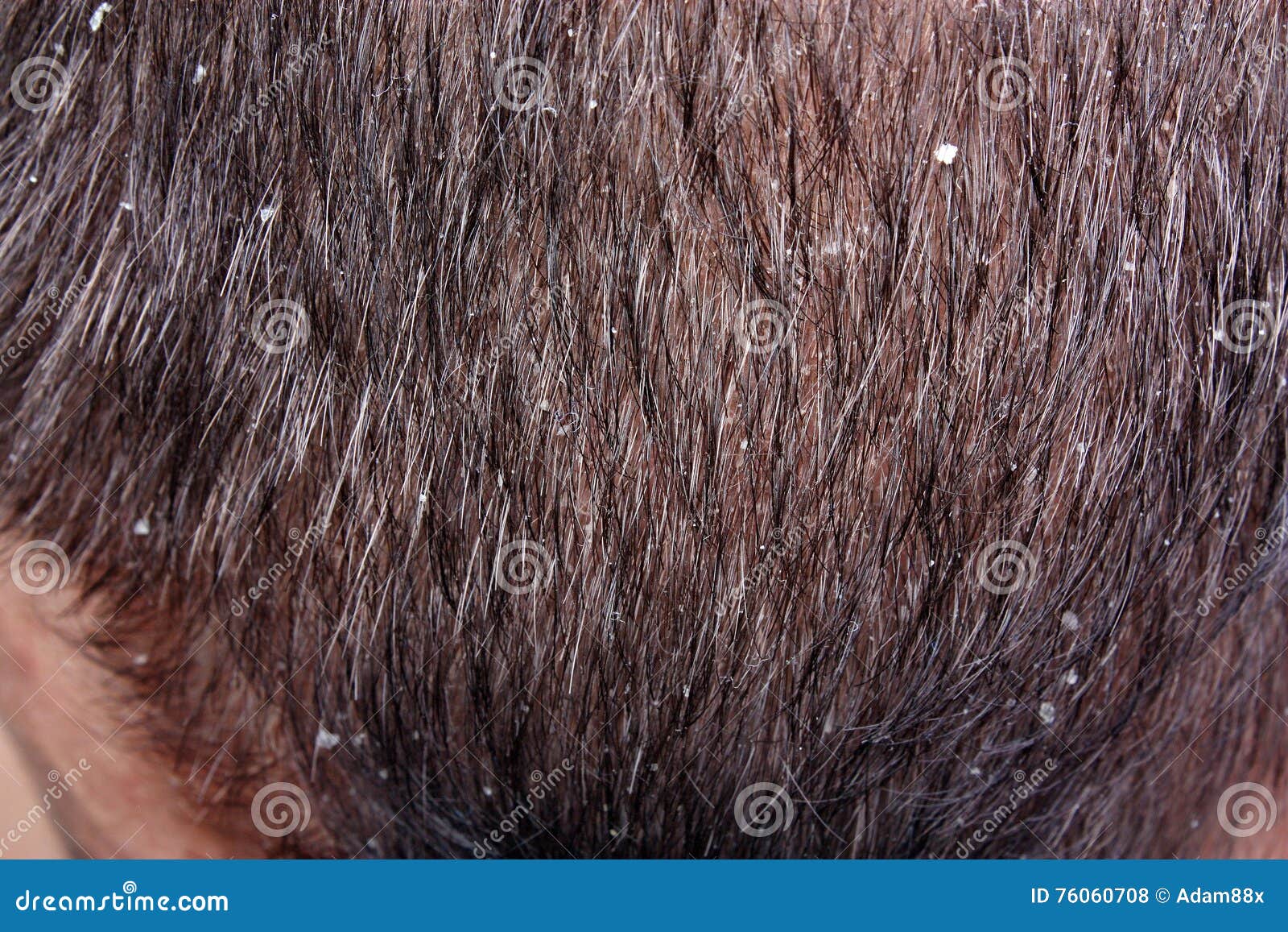 Hoofdroos in het haar stock foto. Image of haar, dermatologie - 76060708