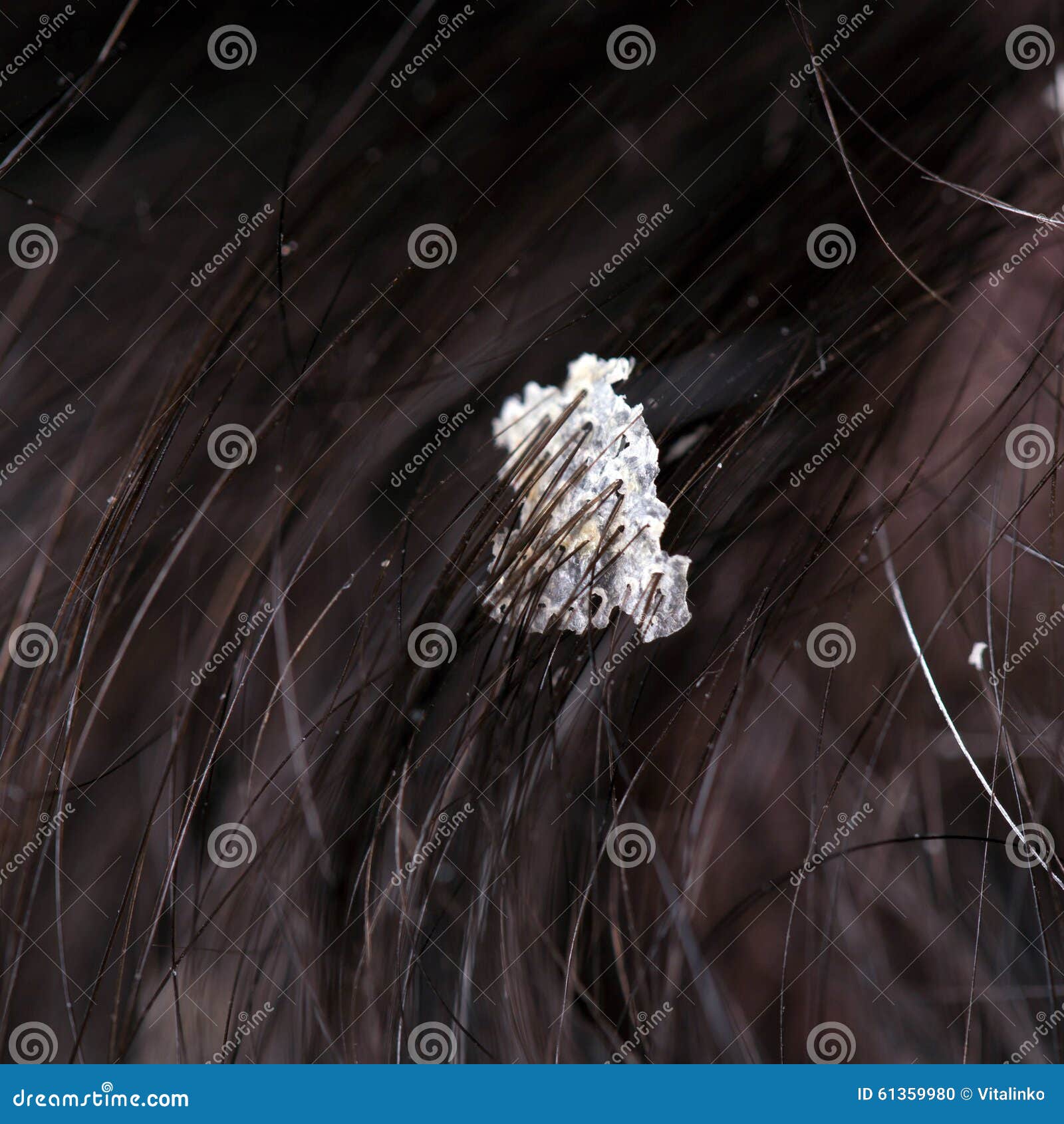 Hoofdroos in Het Haar Vlokkige Scalp Stock Foto - Image of hoofd ...