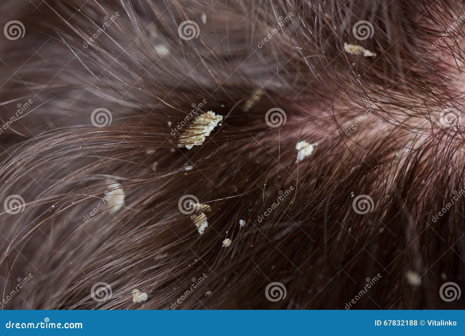 Hoofdroos in Het Haar Vlokkige Scalp Stock Foto - Image of probleem ...