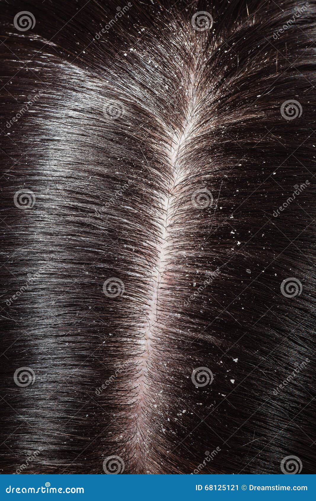 Hoofdroos Op Haar Donker Haar Stock Afbeelding - Image of ongemak ...