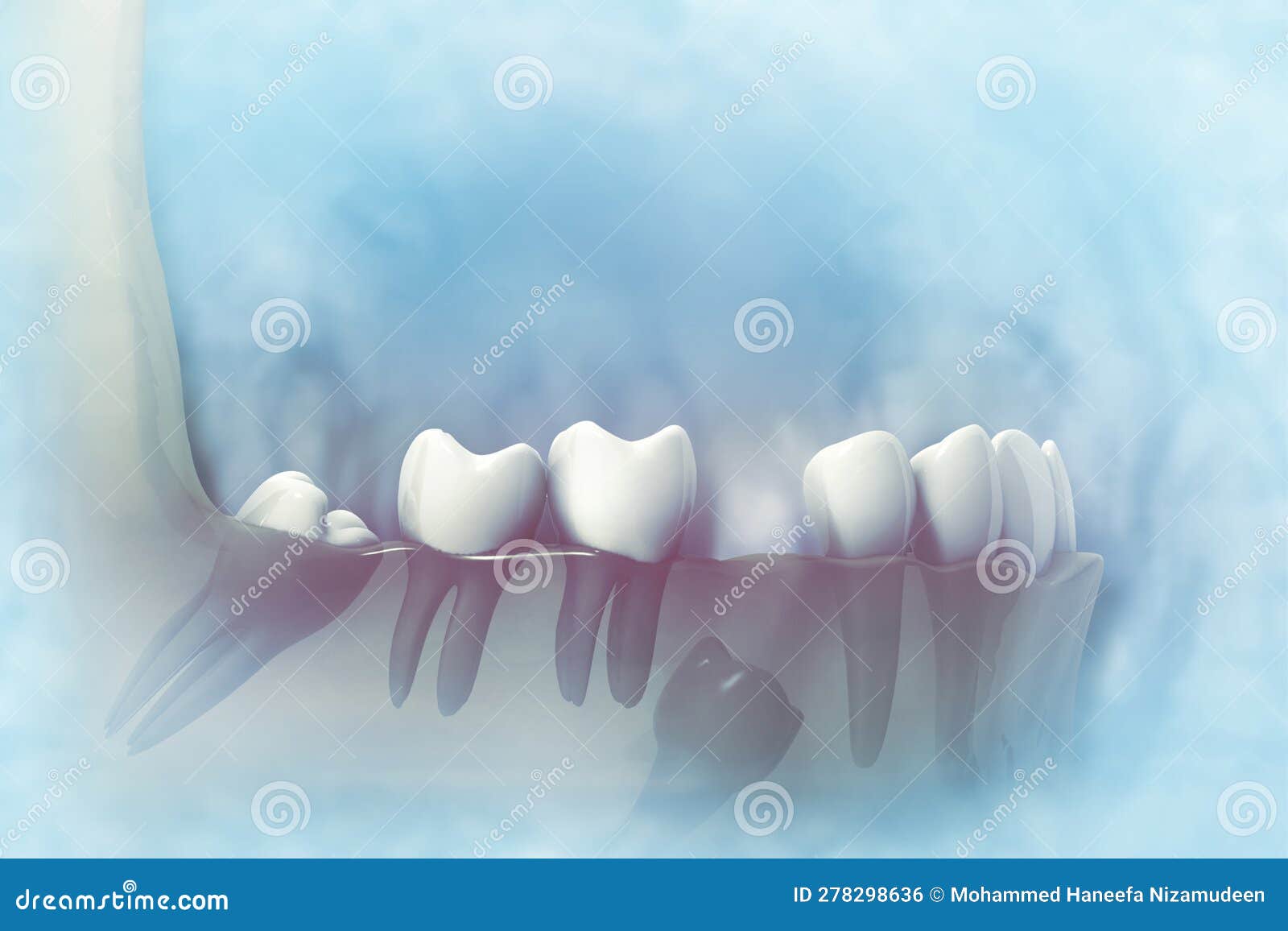 Horizontal Impaction Of Wisdom Tooth. Medically Accurate Tooth 3D ...