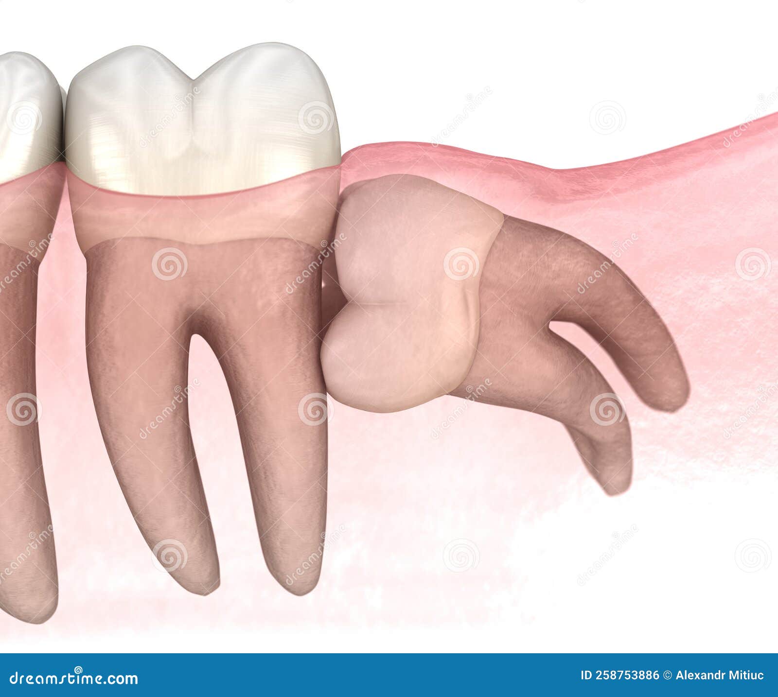 Impaction Tooth Illustration Vector On Blue Background. Dental ...
