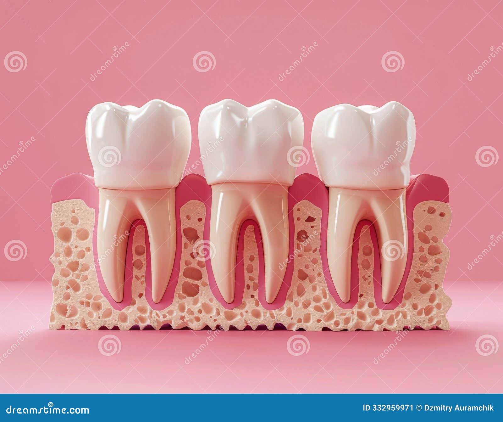 The Horizontal Impaction of the Wisdom Tooth, Shown in Medically ...