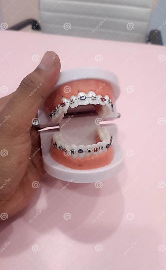 How To Install Brackets on Tooth Models Stock Image - Image of tooth ...