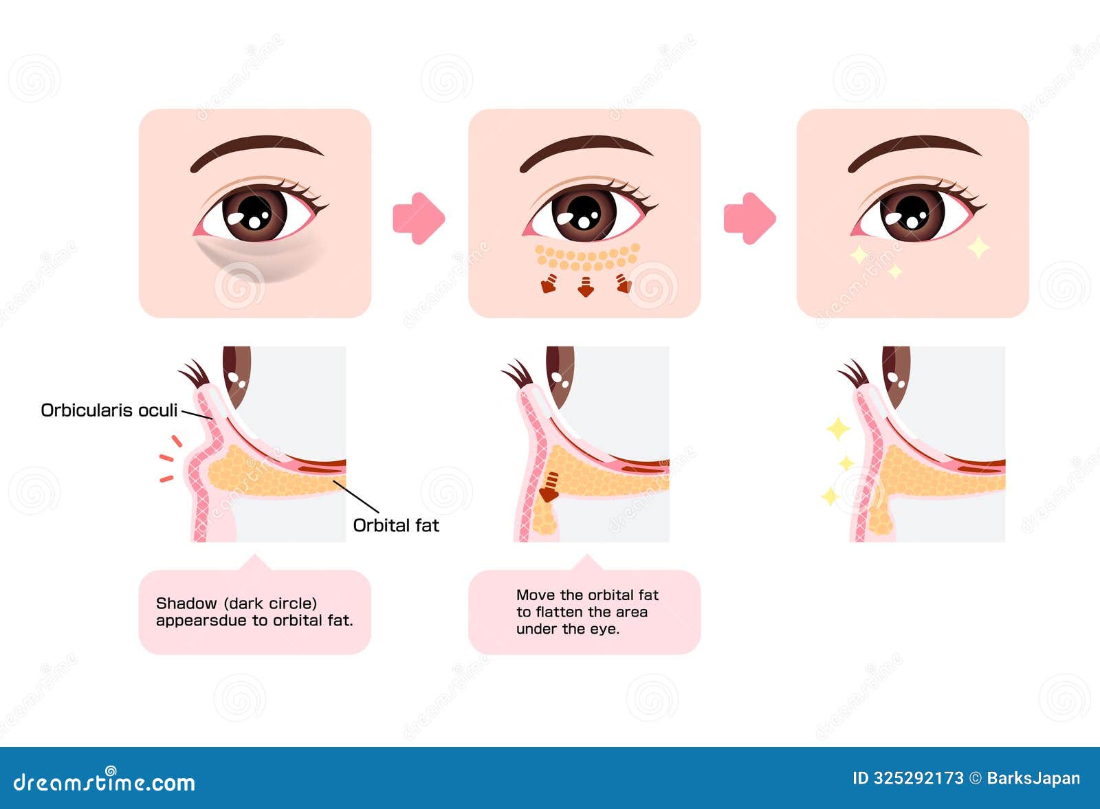 How To Remove Dark Circles Under the Eyes with Lower Blepharoplasty ...