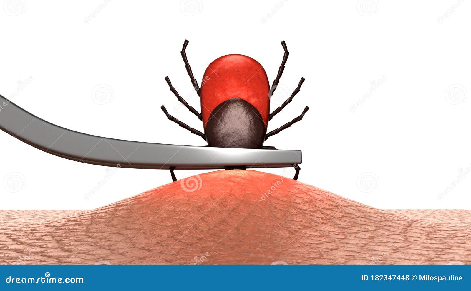 How To Remove a Tick. the Correct Way Using Forceps. 3D-rendering ...