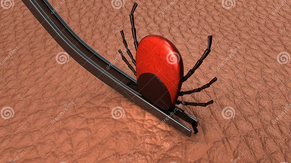 How To Remove a Tick. the Correct Way Using Forceps. 3D-rendering ...