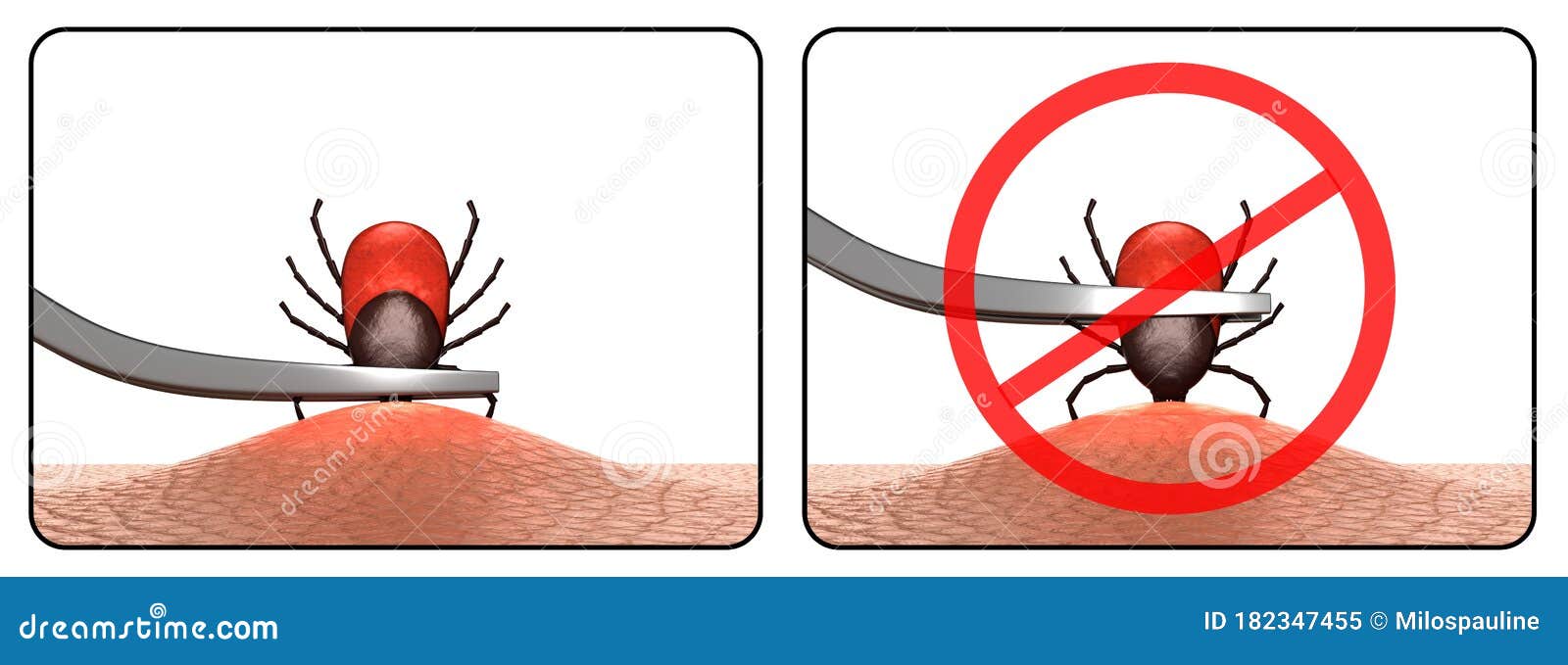 How To Remove a Tick. the Correct Way Using Forceps. 3D-rendering ...